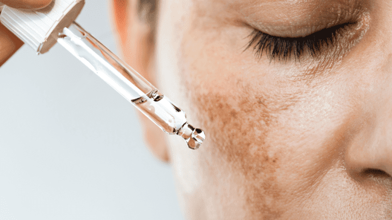 The Ordinary For Pigmentation & Melasma - Best Products To use